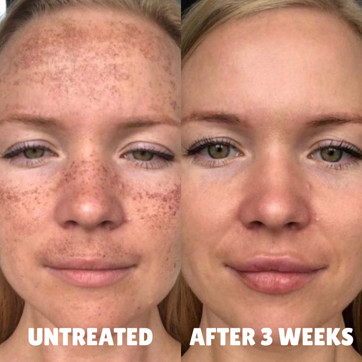 PCOS Hyperpigmentation – Strawberry